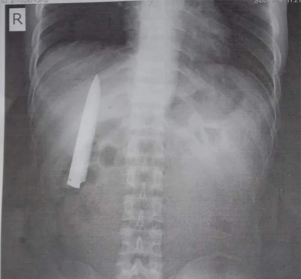 Filipino Man Suffering From Chest Pains Shocked to Find Knife Blade ...